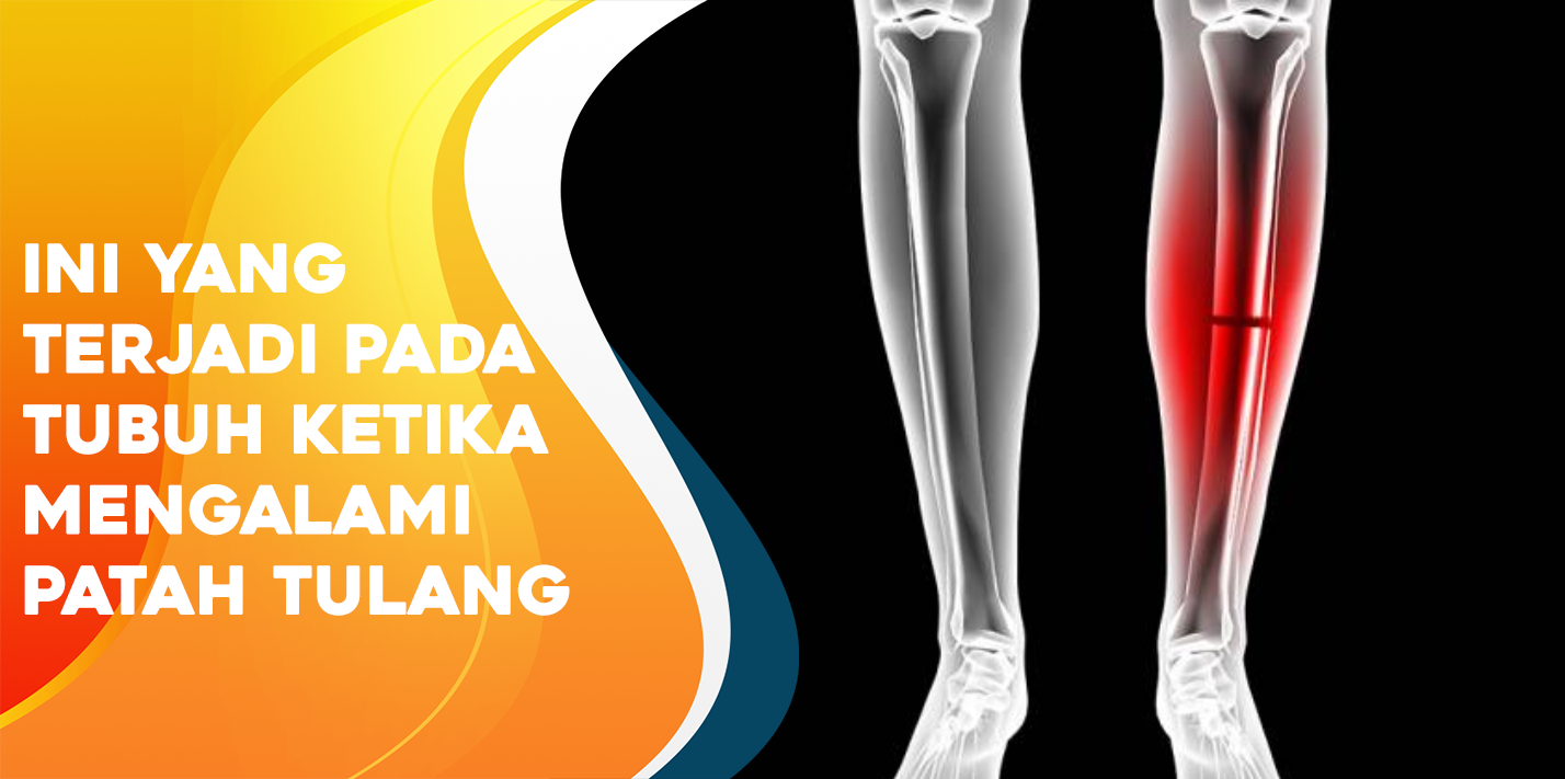Ini yang Terjadi pada Tubuh Ketika Mengalami Patah Tulang
