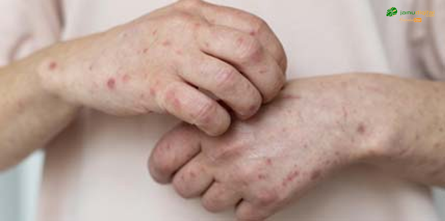 Waspada, Campak jadi Komplikasi Sebabkan Penyakit Berat